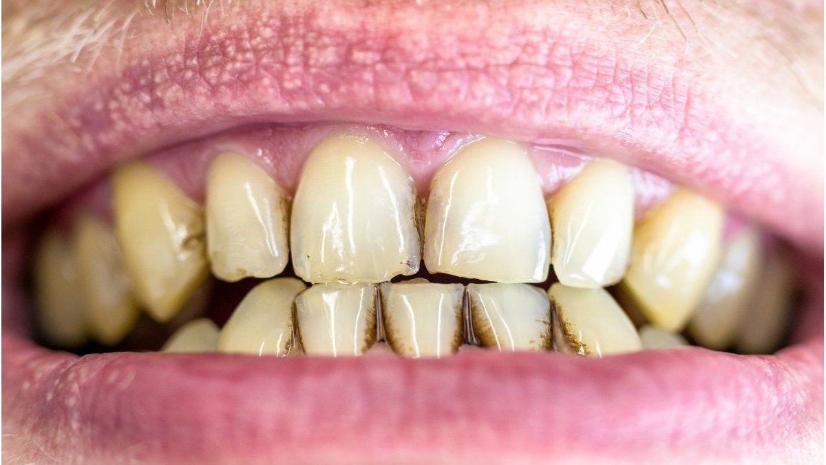 Elimine el sarro de esta manera, antes de que sea tarde