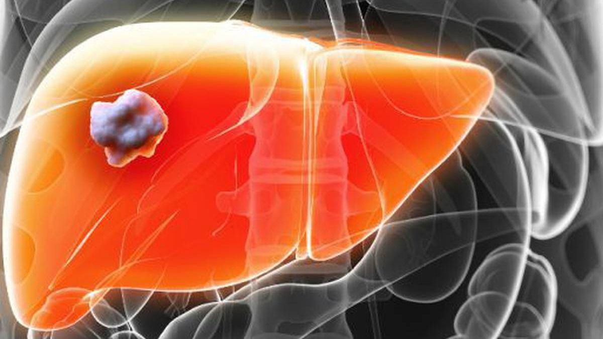 Cáncer de hígado: Si notas esto en la piel, acude al médico