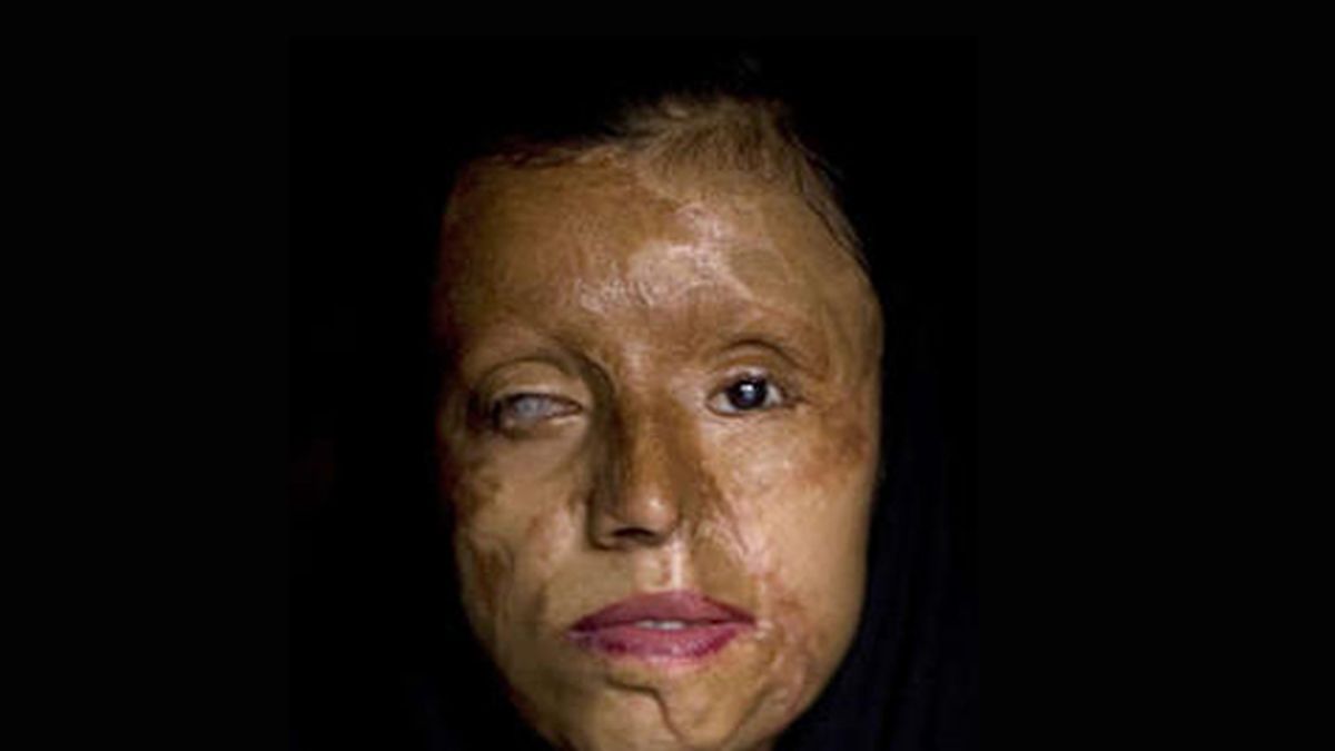 Una gelatina para recomponer rostros desfigurados