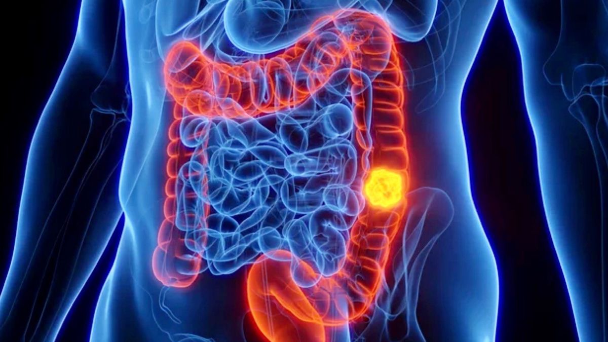 Cáncer colorrectal: Muchos cuidarán mejor su boca después de saber esto