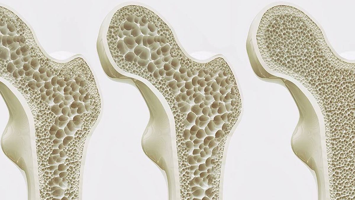 Osteoporosis: Cuidado con este condimento que usa siempre