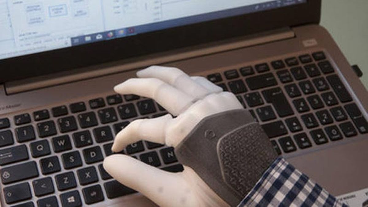 1º implante de una mano robótica permanente a una mujer amputada