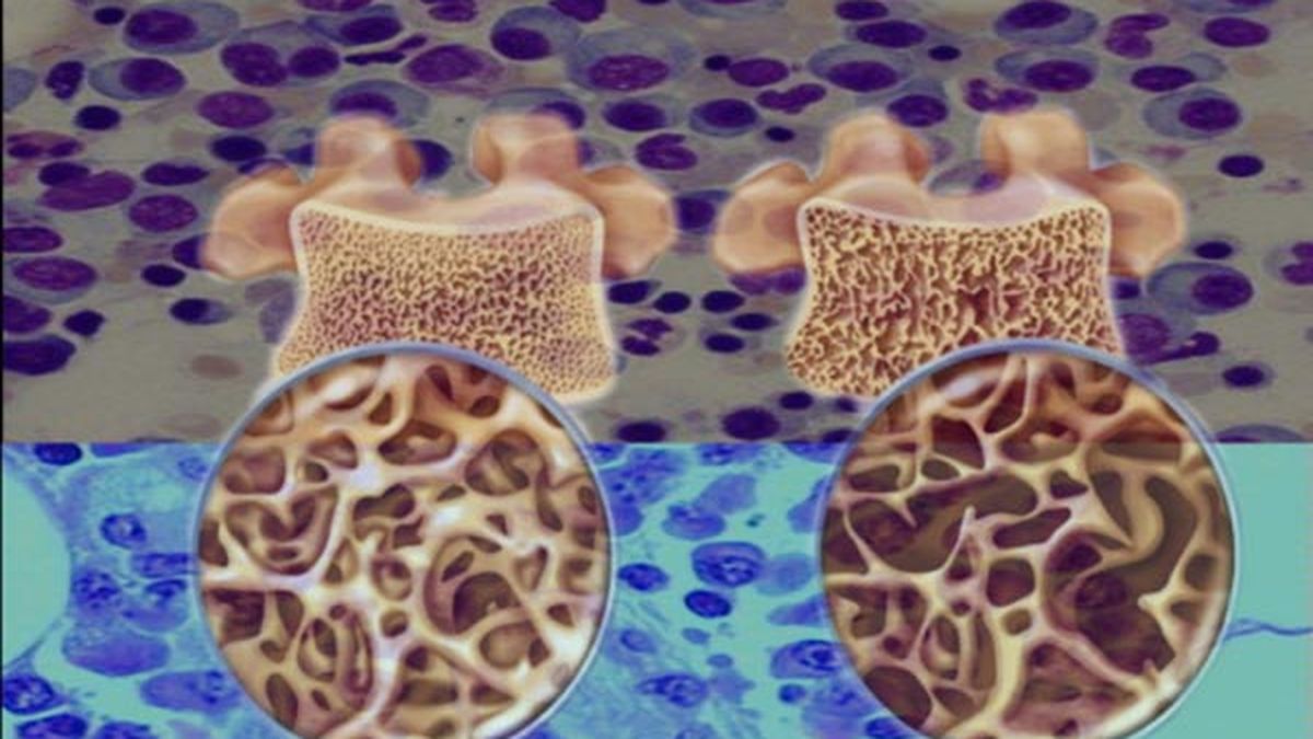 Concientizando sobre un cáncer en la médula ósea