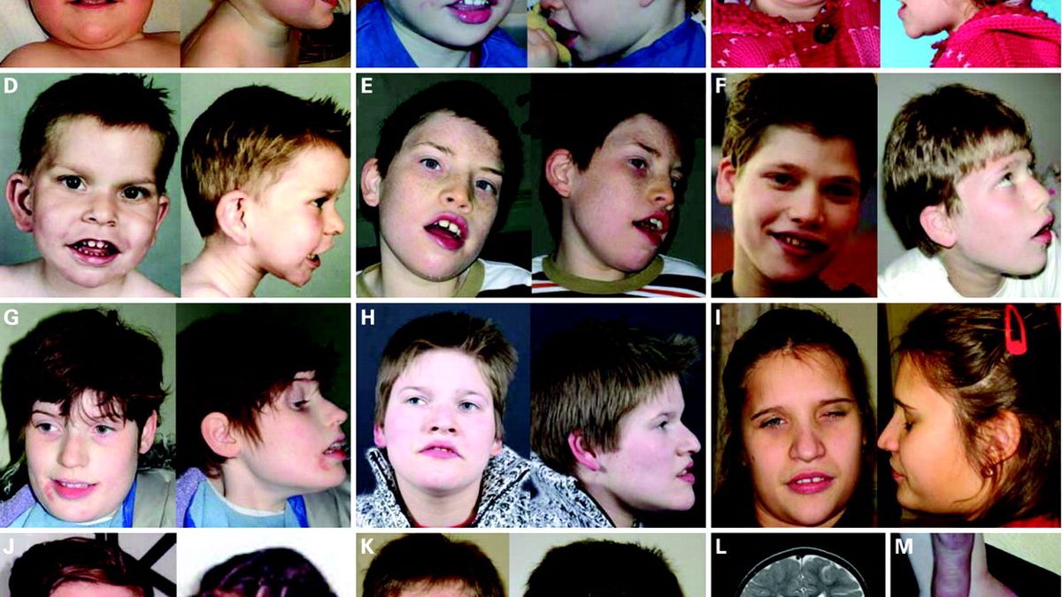 ¿Una enfermedad rara? Síndrome de Pitt-Hopkins